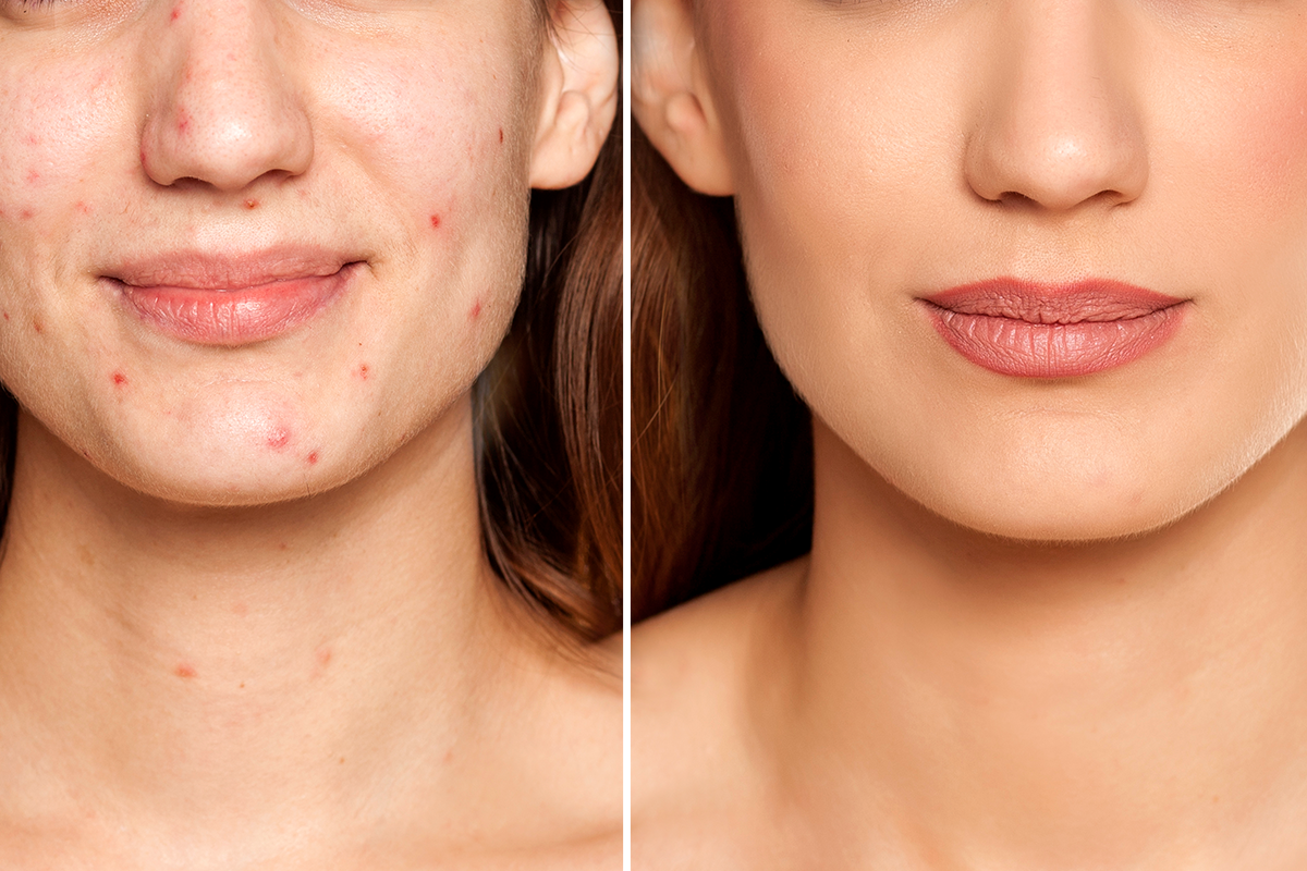 Are You Making Your Acne and Oily Skin Worse? – Ultra Essence Skin Care